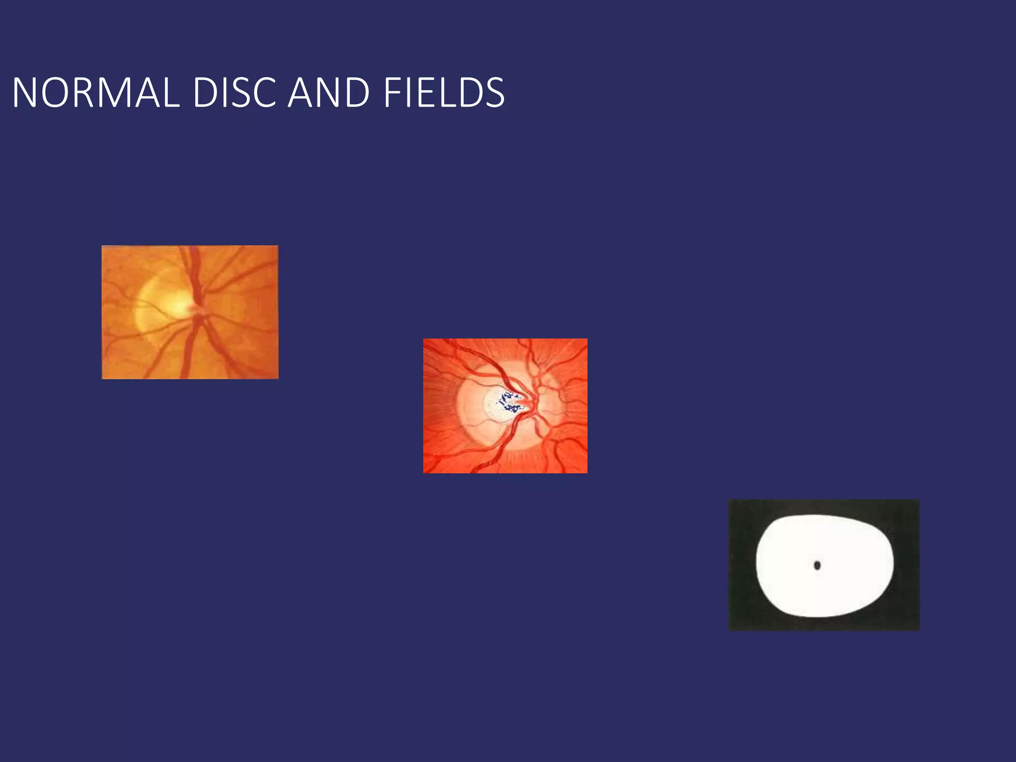 Glaucoma POAG | PPT | Eye and Vision Conditions | Diseases and Conditions