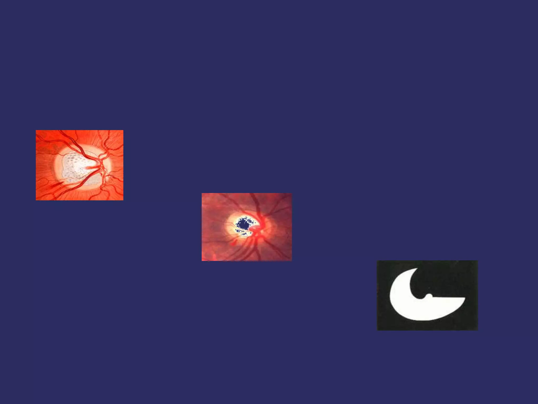 Glaucoma POAG | PPT | Eye and Vision Conditions | Diseases and Conditions