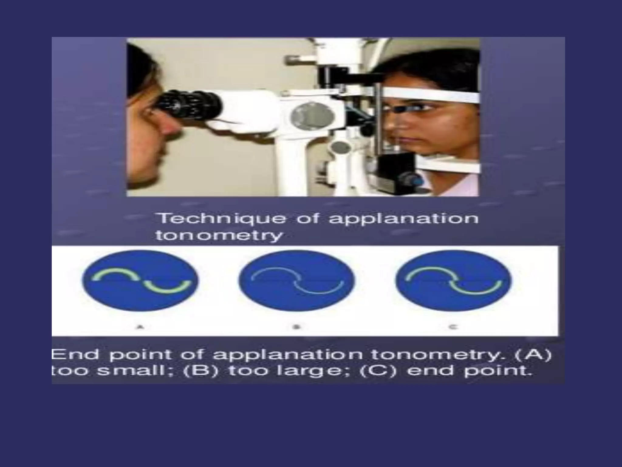 Glaucoma POAG | PPT | Eye and Vision Conditions | Diseases and Conditions