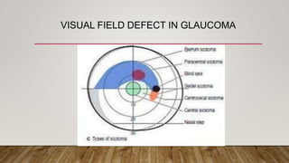 Glaucoma dr.eqbal | PPT