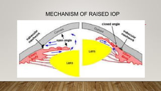 Glaucoma dr.eqbal | PPT
