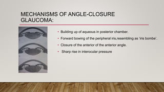 Glaucoma dr.eqbal | PPTX