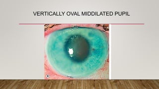 Glaucoma dr.eqbal | PPT