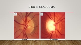 Glaucoma dr.eqbal | PPT