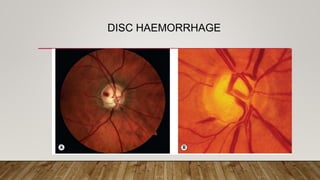 Glaucoma dr.eqbal | PPT