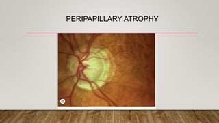 Glaucoma dr.eqbal | PPT