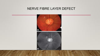 Glaucoma dr.eqbal | PPT
