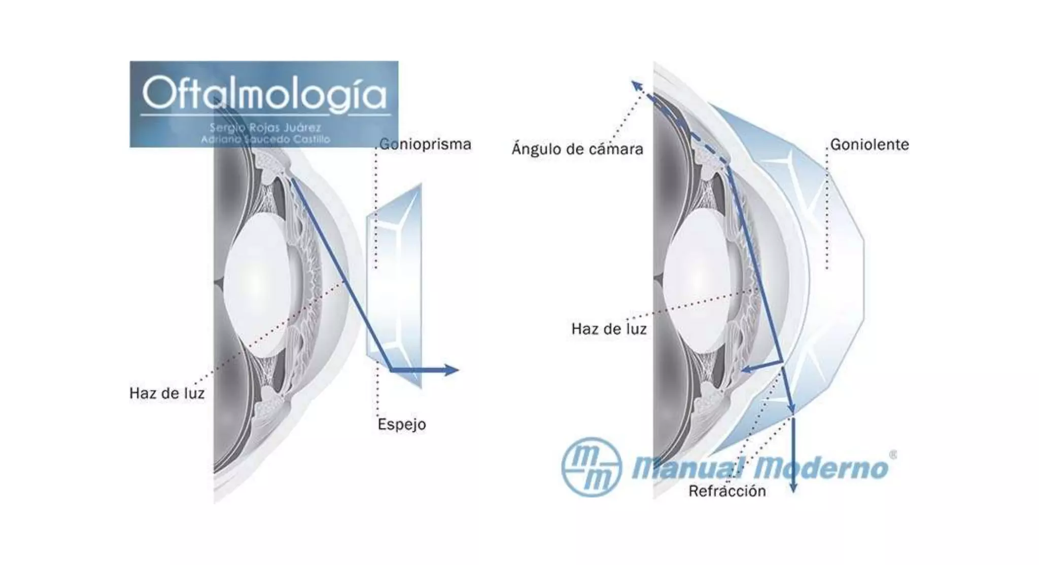 Glaucoma (generalidades y glaucoma de angulo abierto) | PPT