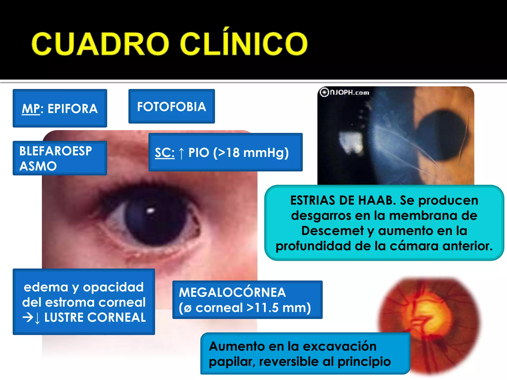 Glaucoma evaluación del nervio óptico, glaucoma neonatal y manitol | PPT