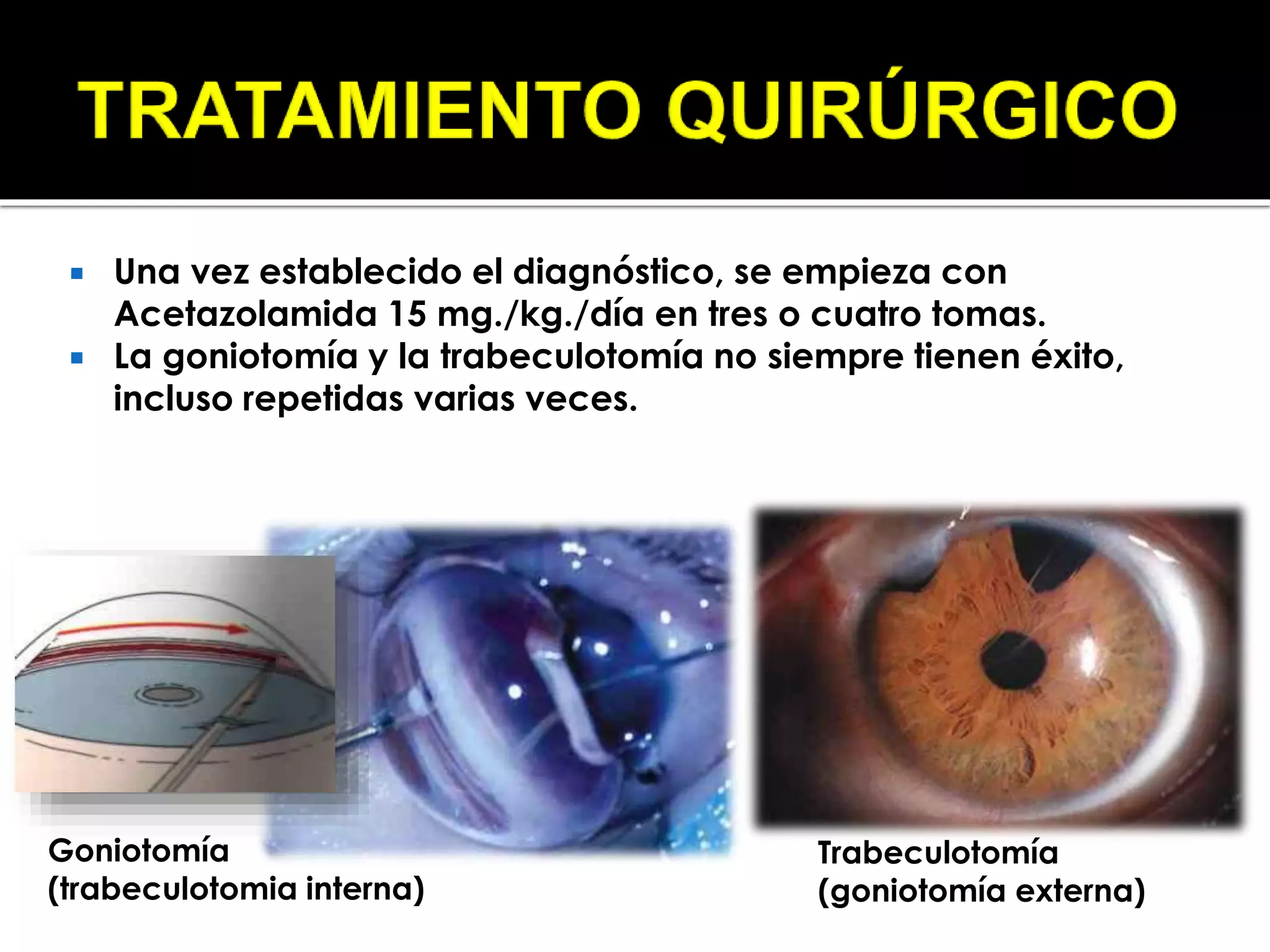 Glaucoma evaluación del nervio óptico, glaucoma neonatal y manitol | PPT