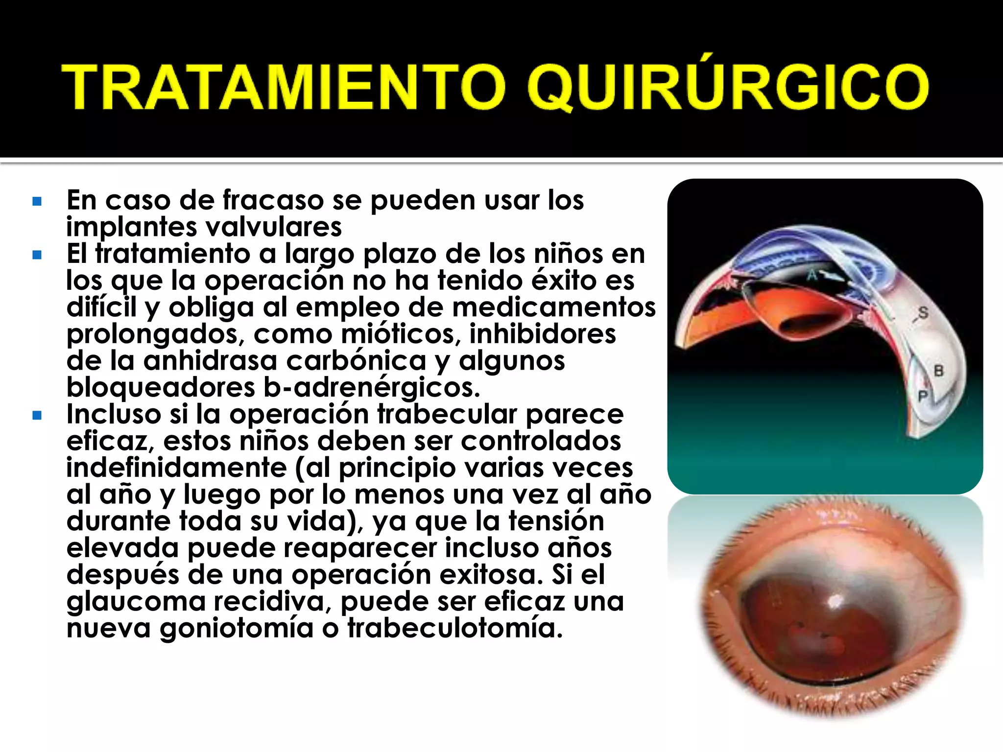 Glaucoma evaluación del nervio óptico, glaucoma neonatal y manitol | PPT