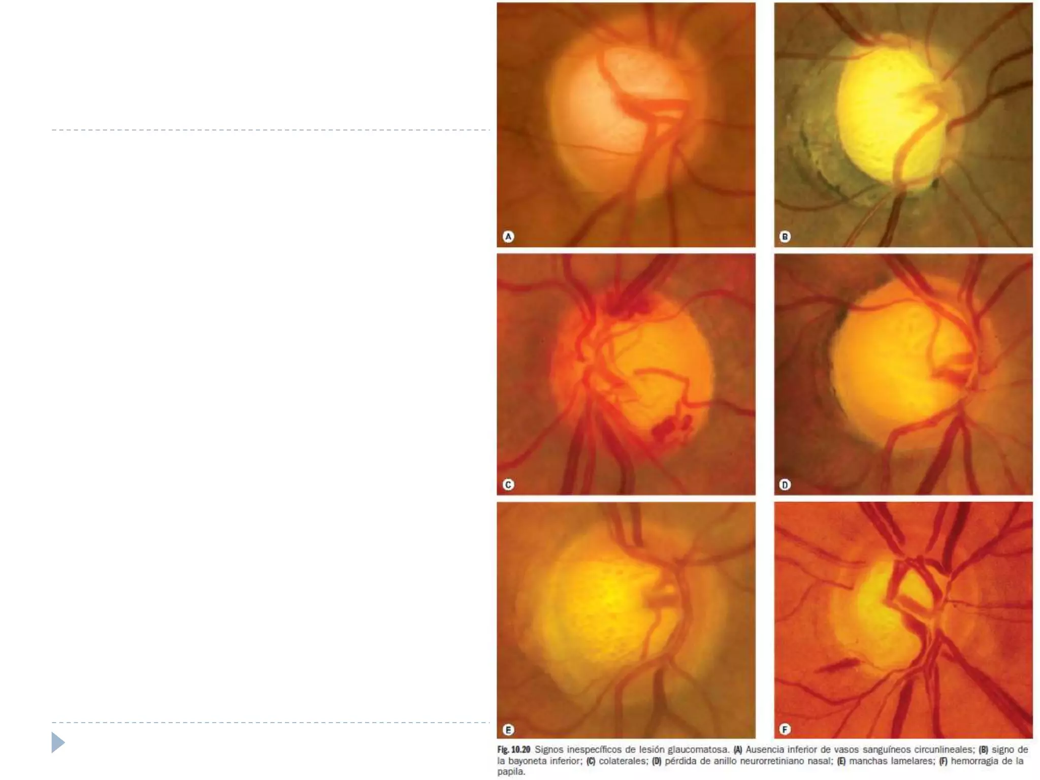 Glaucoma evaluación del nervio óptico, glaucoma neonatal y manitol | PPT