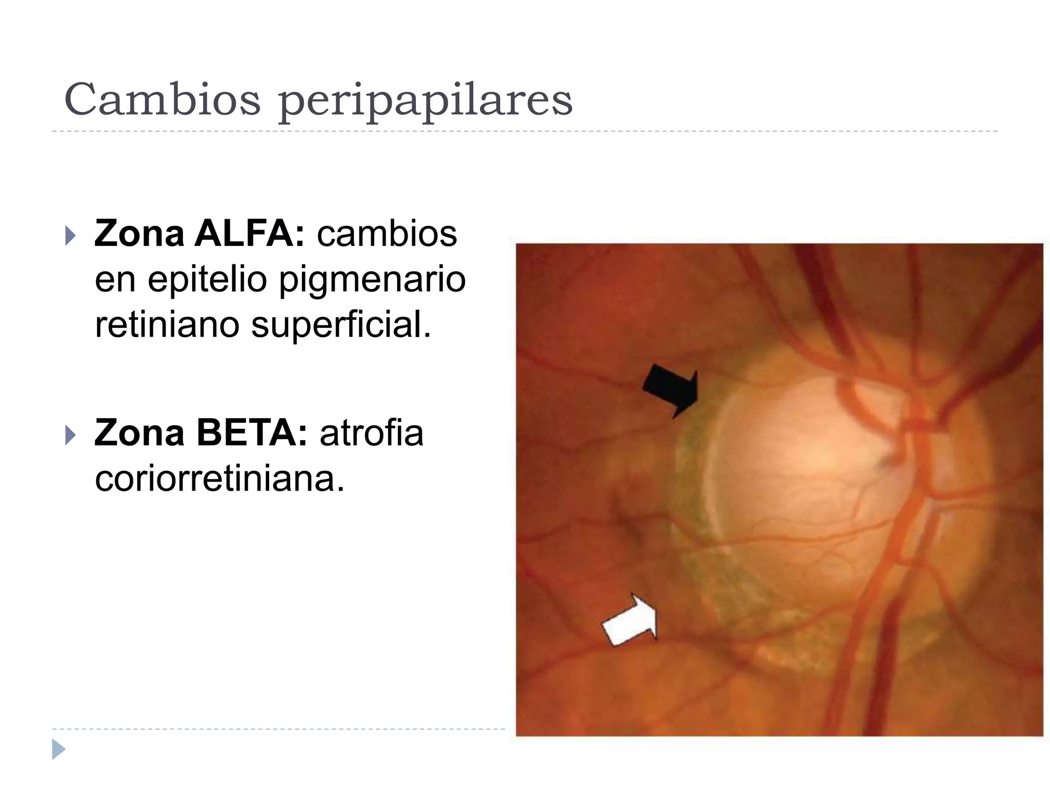 Glaucoma evaluación del nervio óptico, glaucoma neonatal y manitol | PPT