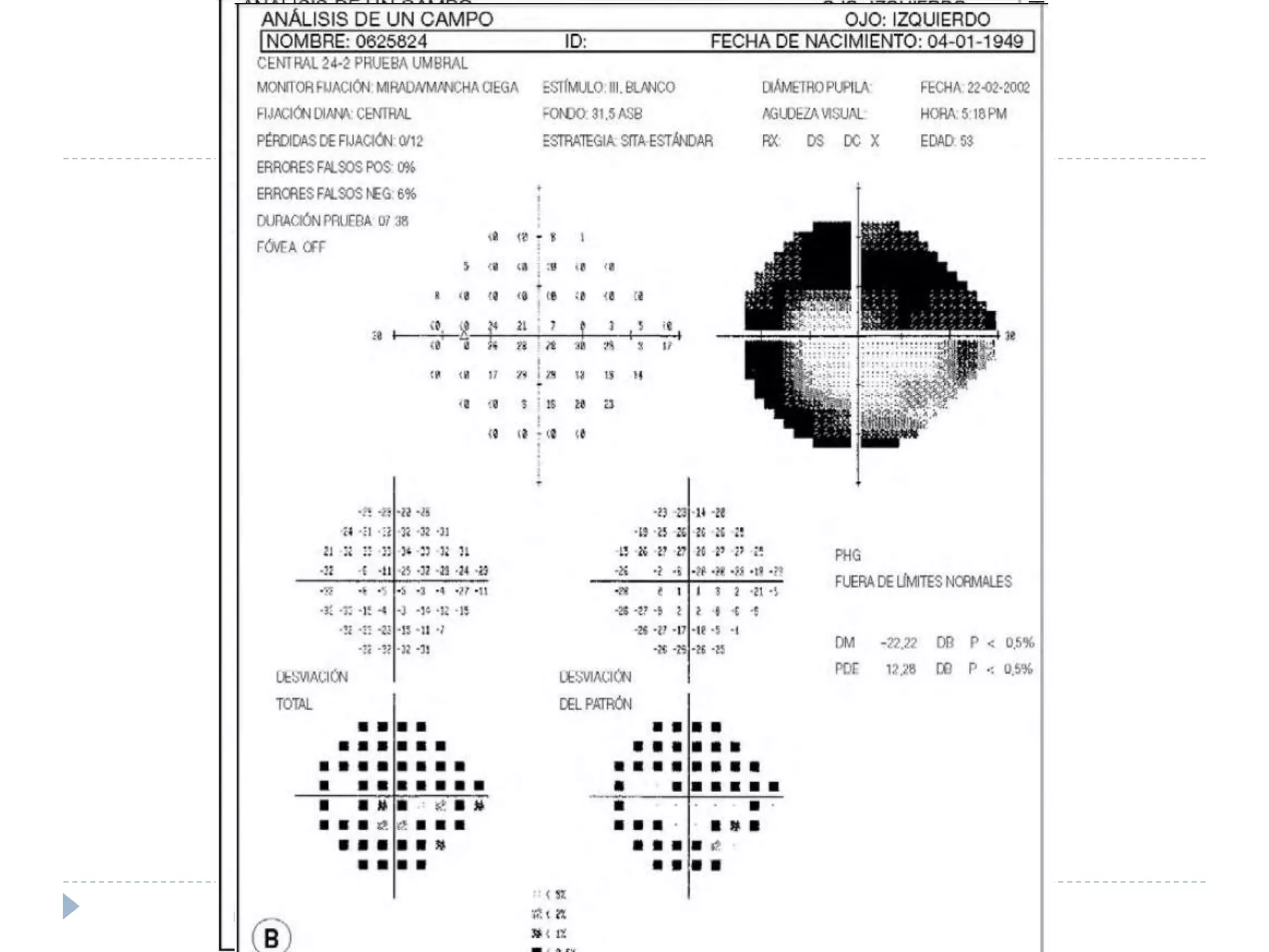 Glaucoma evaluación del nervio óptico, glaucoma neonatal y manitol | PPT
