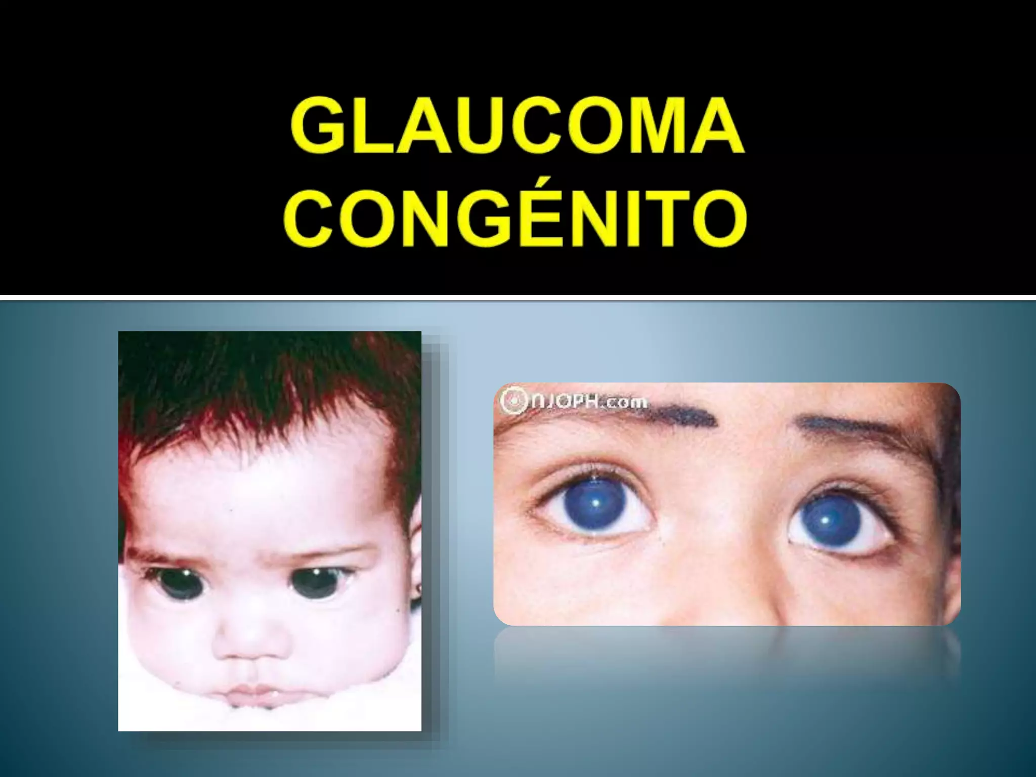 Glaucoma evaluación del nervio óptico, glaucoma neonatal y manitol | PPT