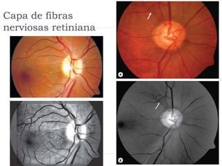 Glaucoma evaluación del nervio óptico, glaucoma neonatal y manitol | PPTX