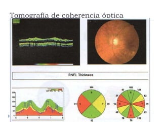 Glaucoma evaluación del nervio óptico, glaucoma neonatal y manitol | PPTX