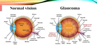 glaucoma-final.pptx