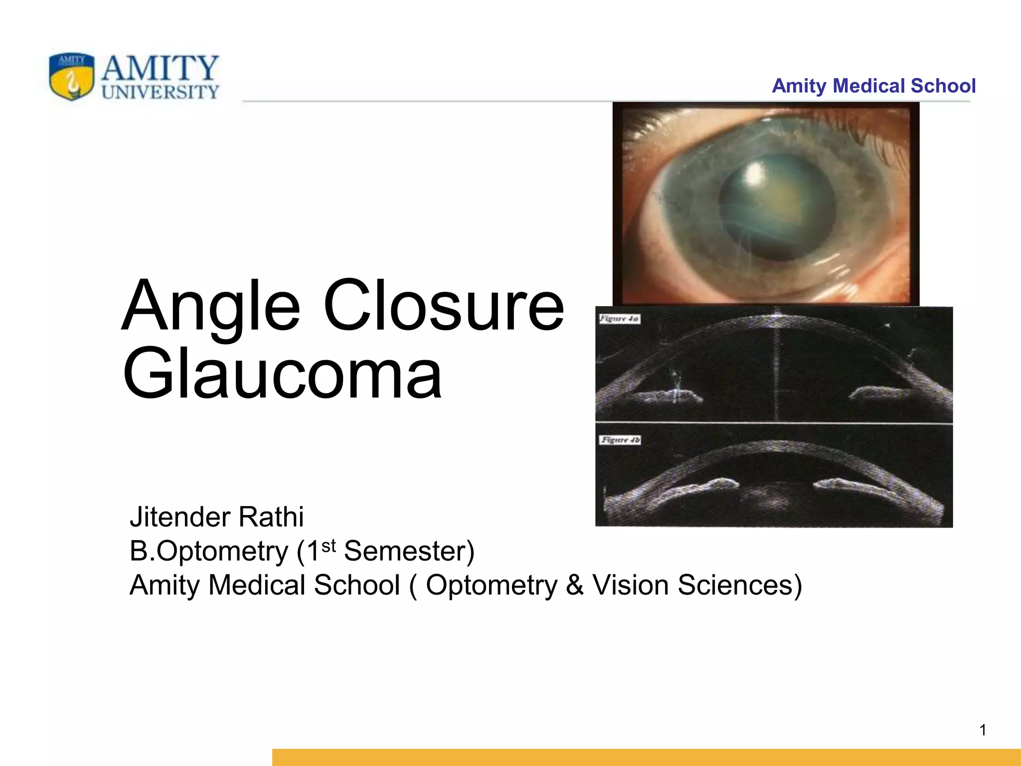 Angle Closure Glaucoma | PPT