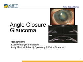Angle Closure Glaucoma | PPT