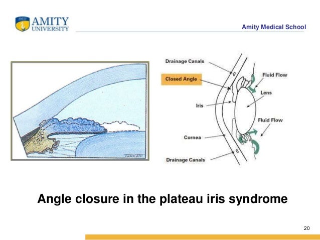 Angle Closure Glaucoma