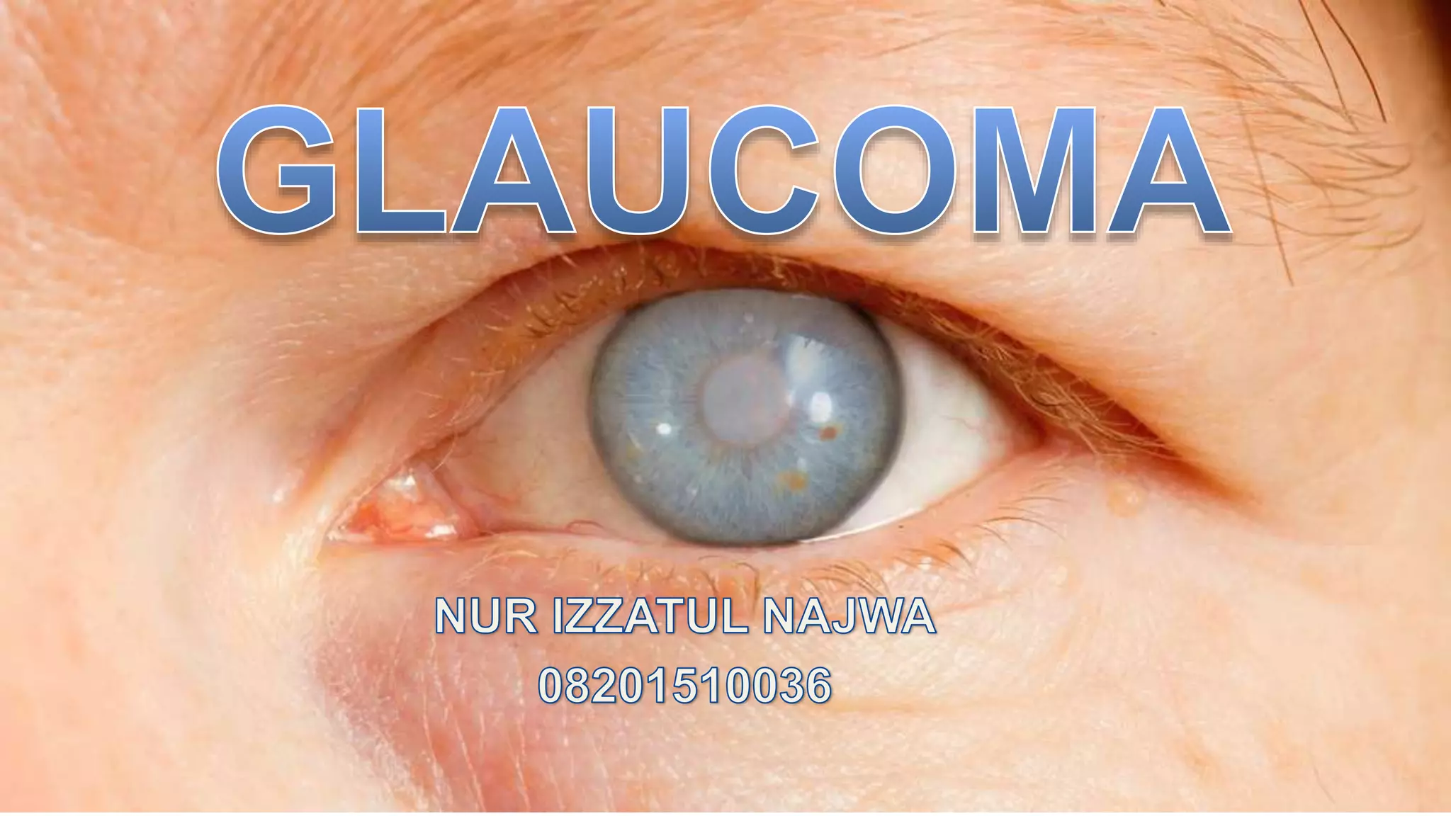 Glaucoma | PPTX