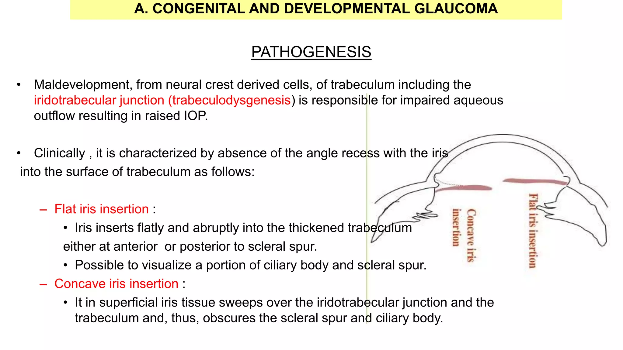 Glaucoma | PPTX