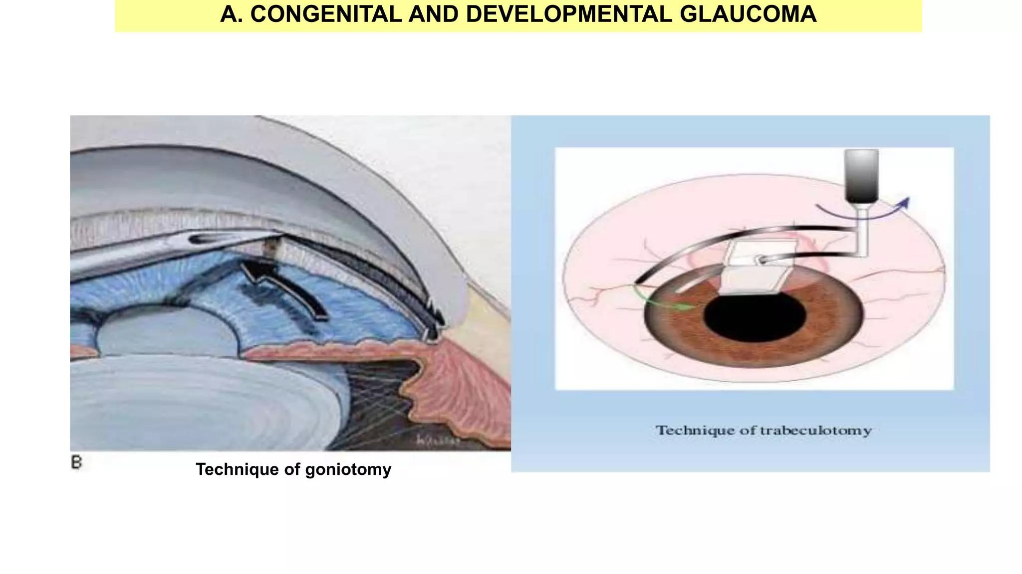 Glaucoma | PPTX