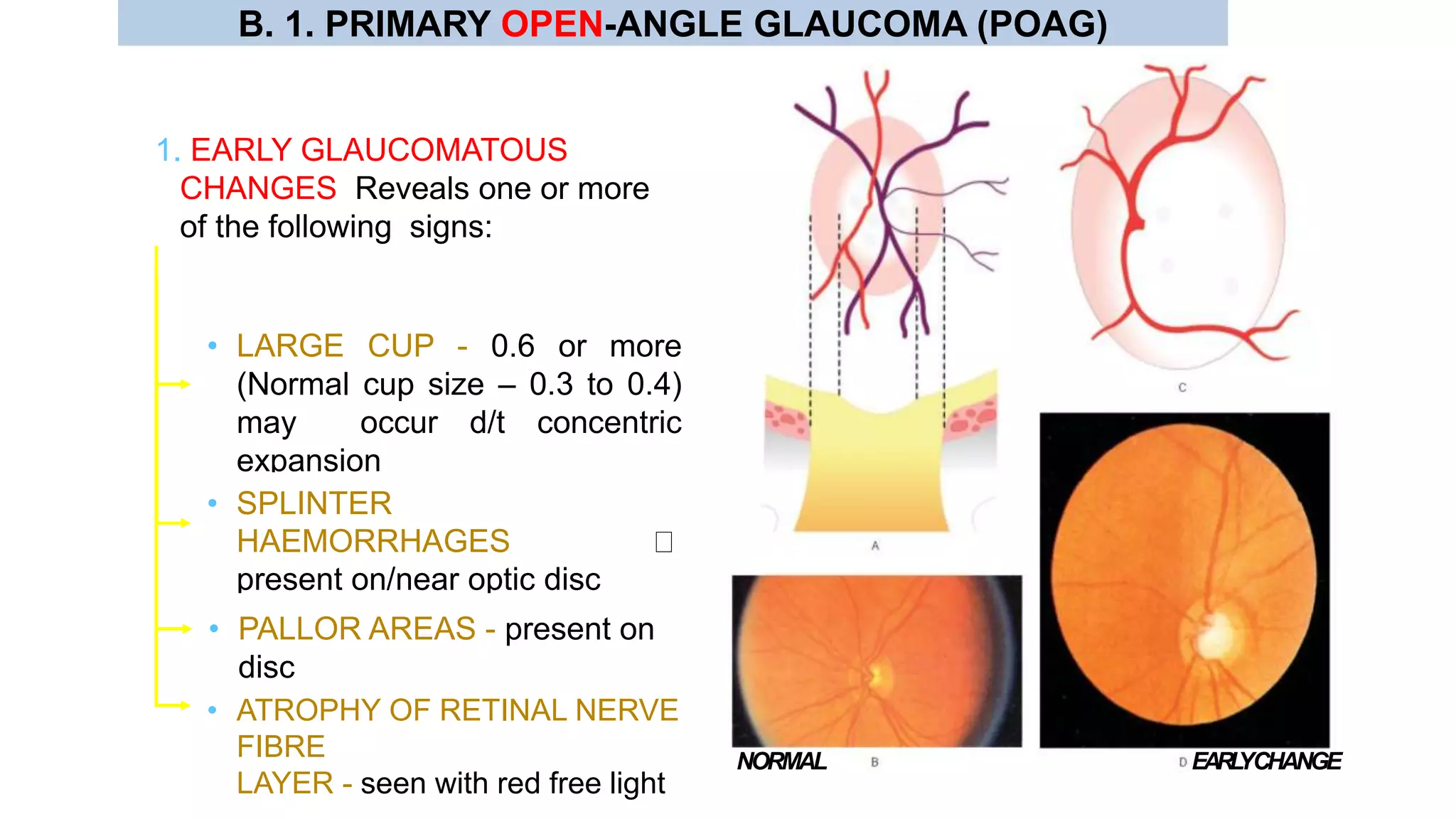 Glaucoma | PPTX
