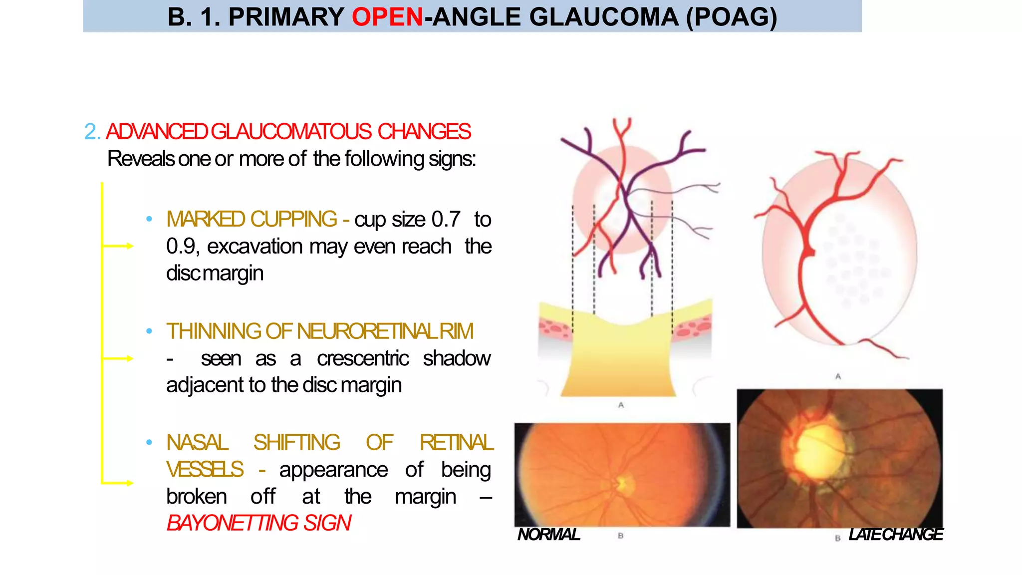 Glaucoma | PPTX