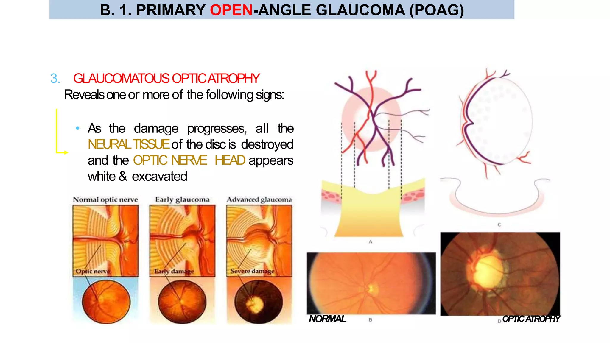 Glaucoma | PPTX