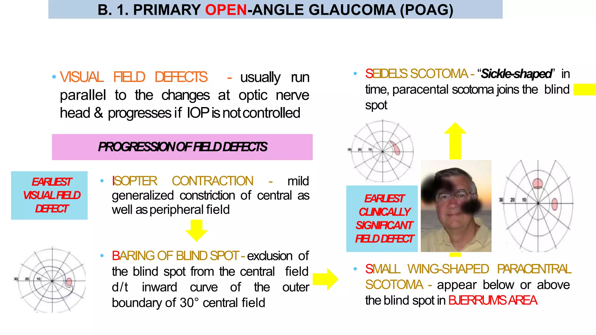 Glaucoma | PPTX
