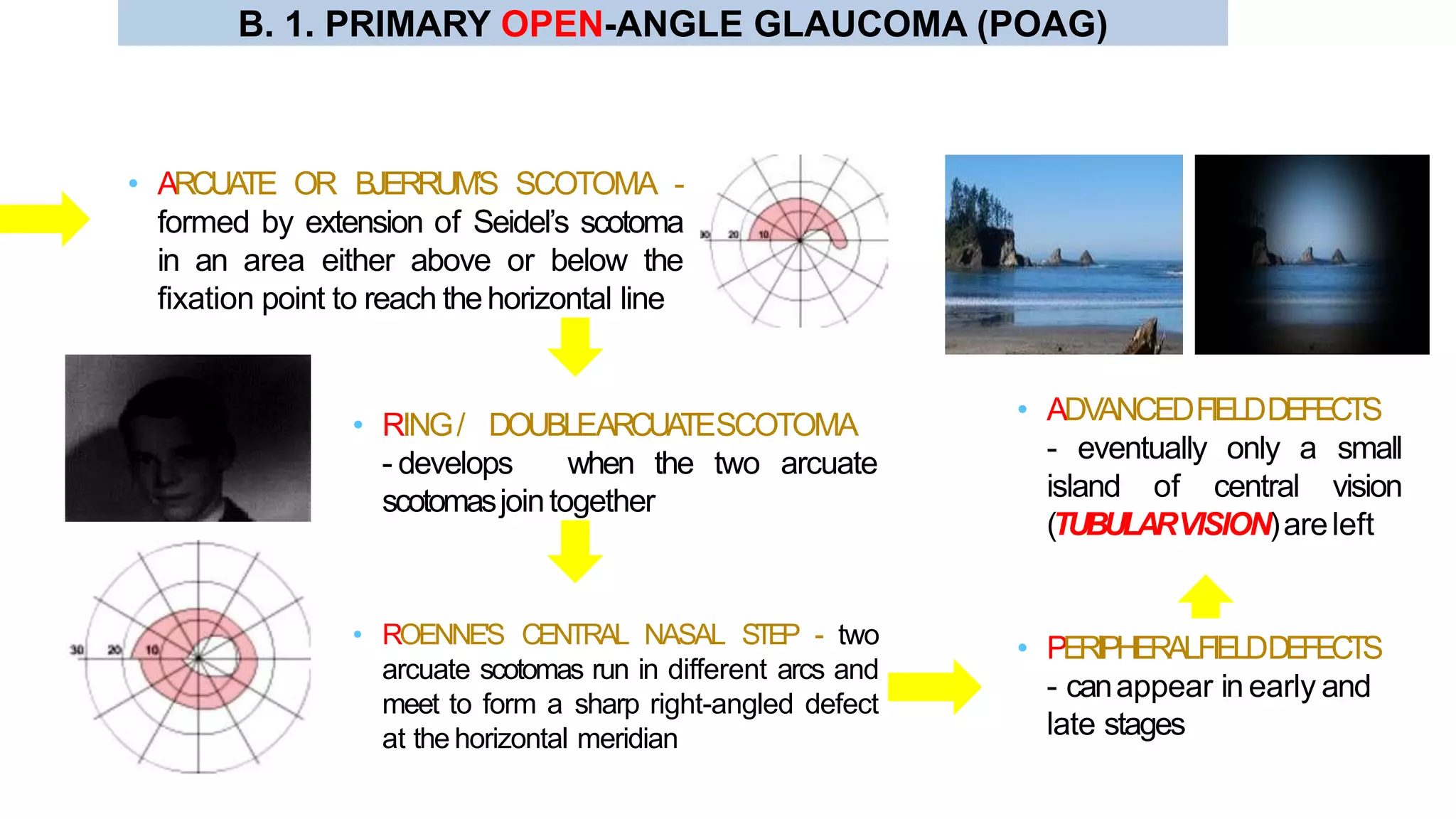 Glaucoma | PPTX