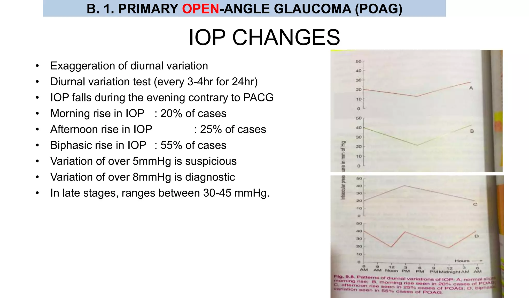 Glaucoma | PPTX