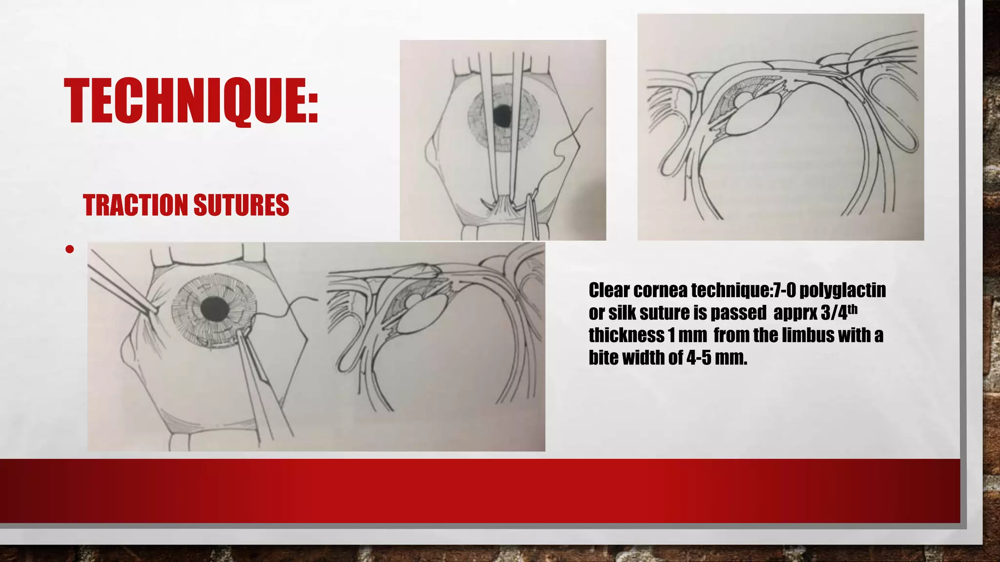surgical management of glaucoma | PPTX