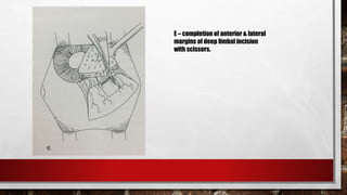 surgical management of glaucoma | PPTX