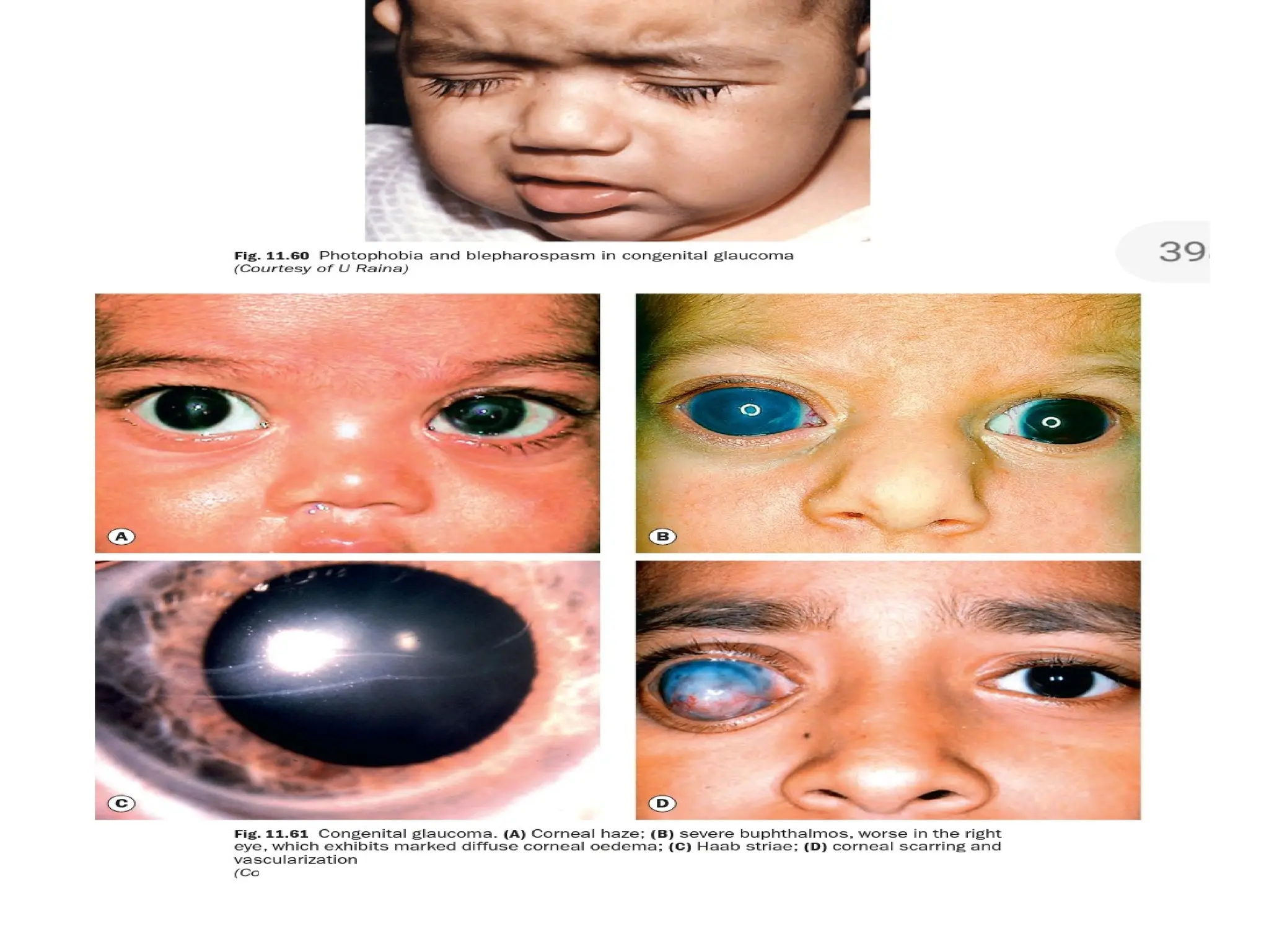 glaucoma 2.pptx234567890-=-09876543wdfghj | PPTX
