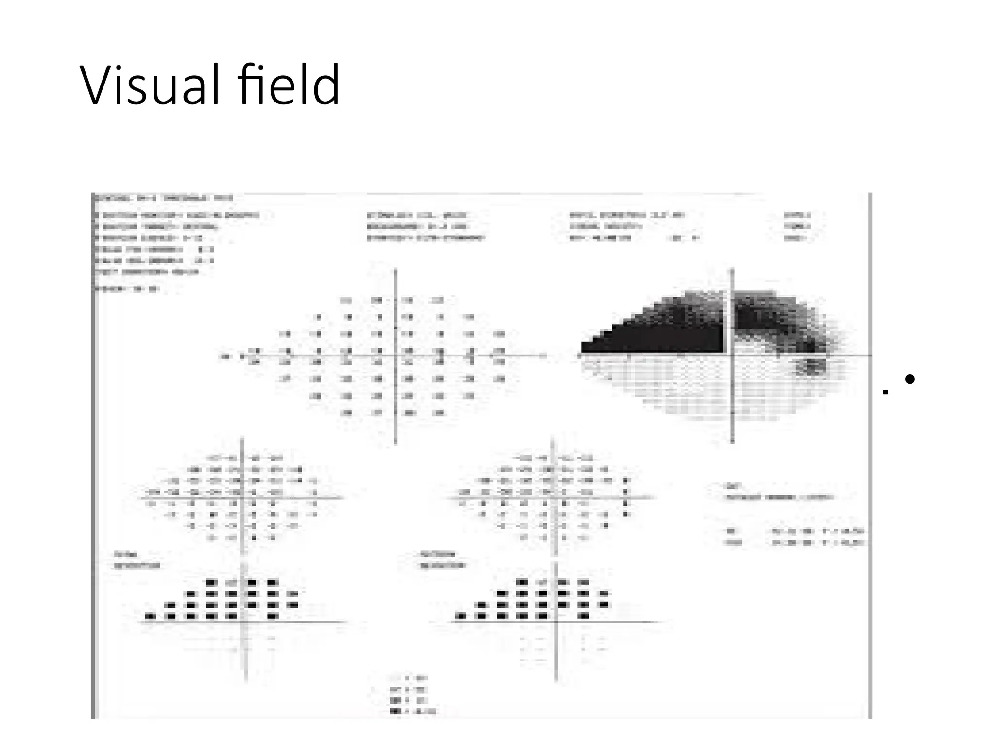glaucoma 2.pptx234567890-=-09876543wdfghj | PPTX