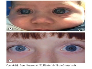 glaucoma 2.pptx234567890-=-09876543wdfghj | PPTX