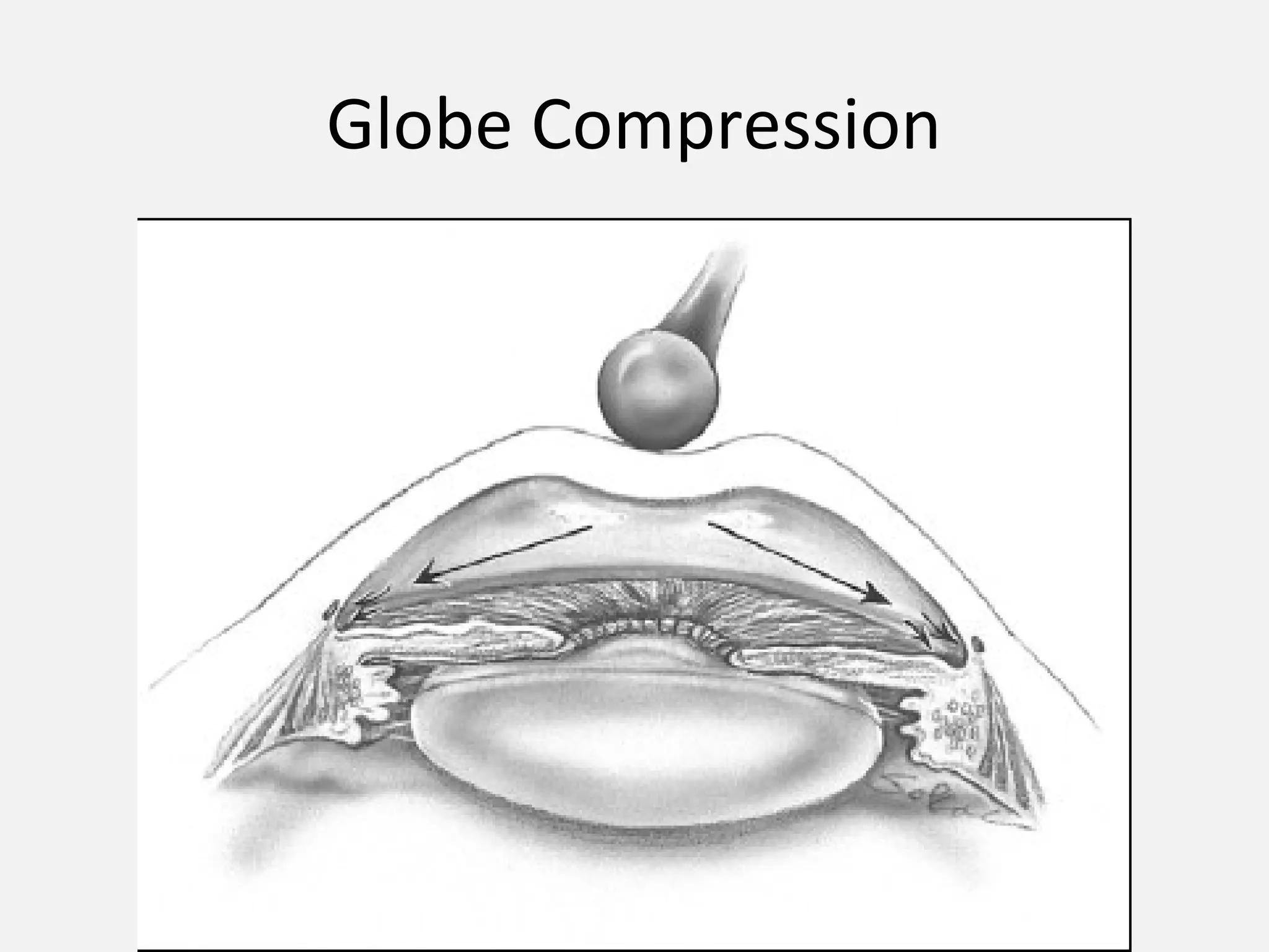 Glaucoma 2 primary angle closure glaucoma,dr.k.n.jha,02.11.16