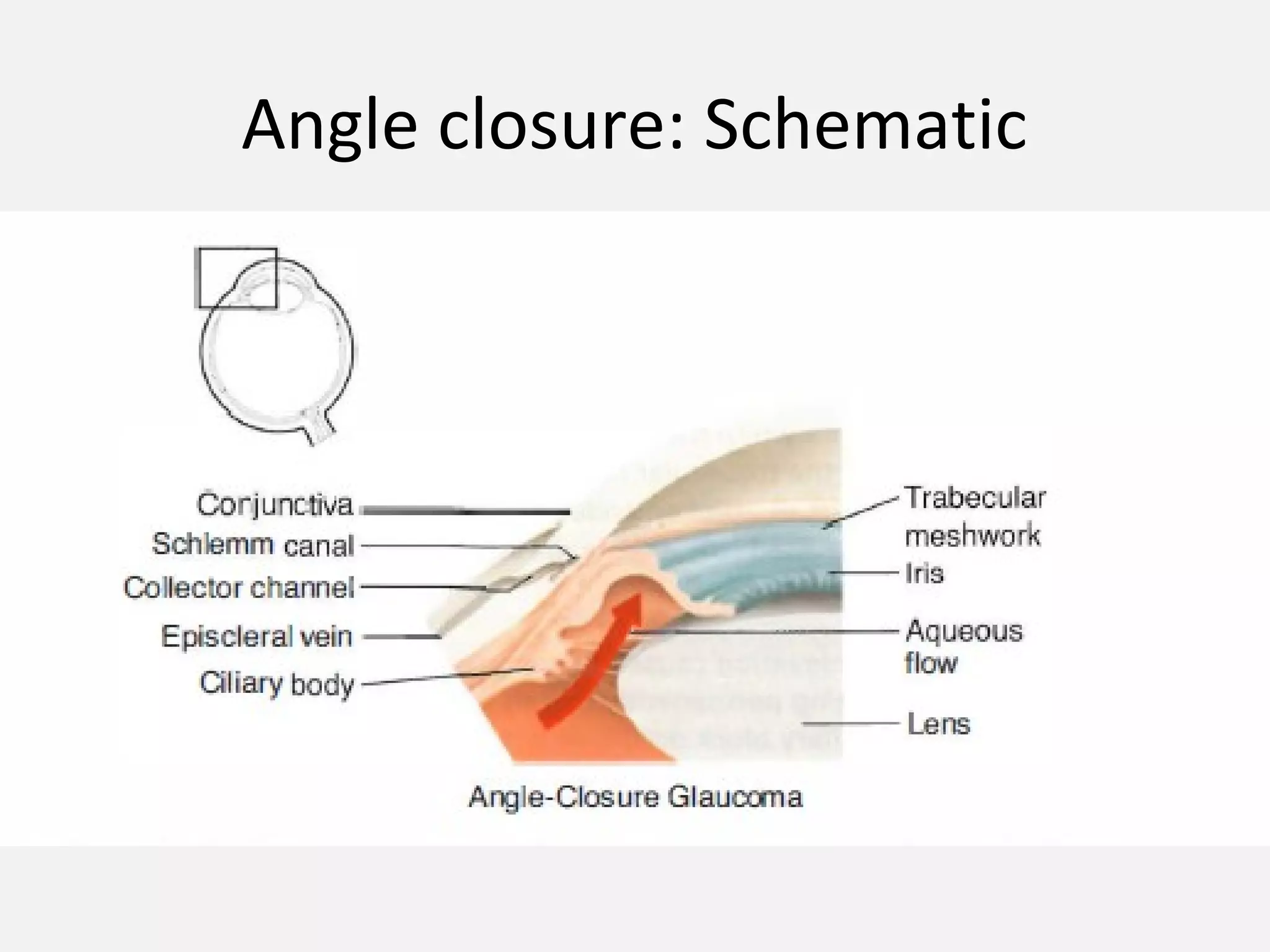 Glaucoma 2 primary angle closure glaucoma,dr.k.n.jha,02.11.16
