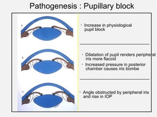 Glaucoma 2 primary angle closure glaucoma,dr.k.n.jha,02.11.16