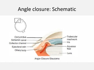 Glaucoma 2 primary angle closure glaucoma,dr.k.n.jha,02.11.16