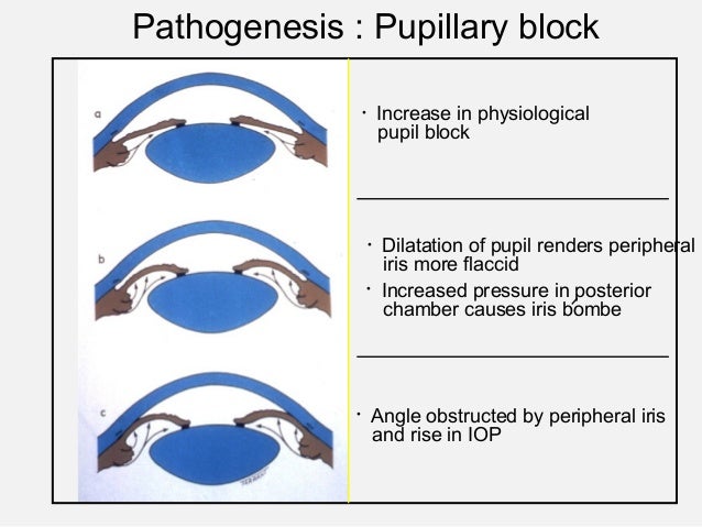 In closed-angle glaucoma, is aqueous humor trapped in the anterior or ...