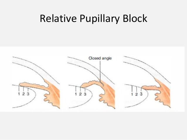 Glaucoma 2 primary angle closure glaucoma,dr.k.n.jha,02.11.16
