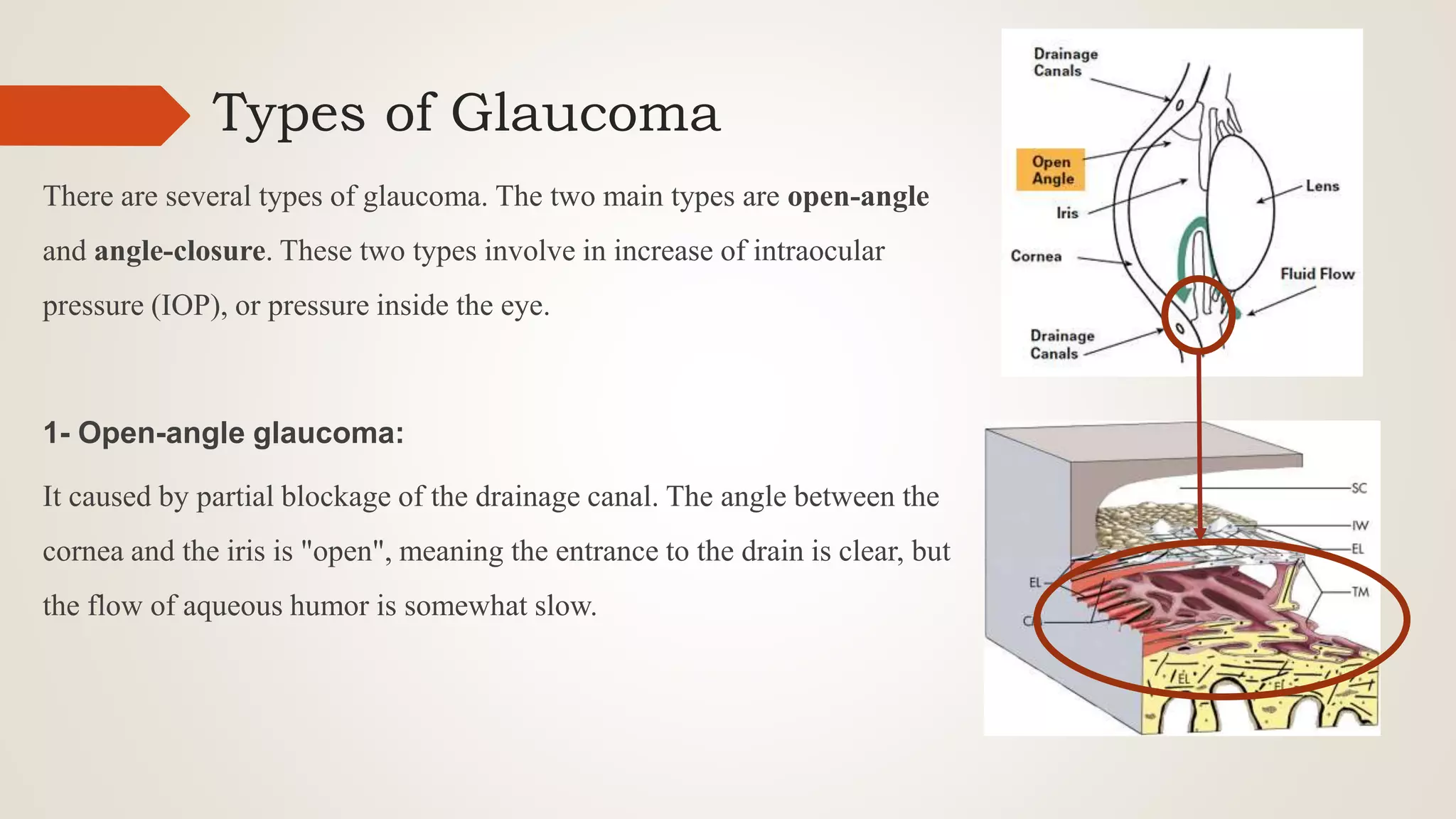 Congenital Glaucoma | PPTX