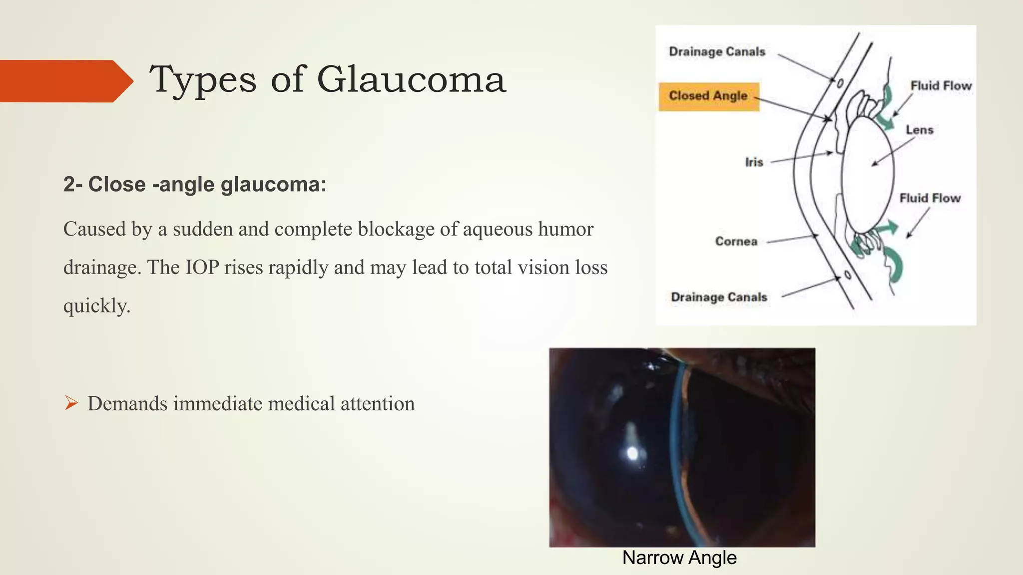 Congenital Glaucoma | PPTX