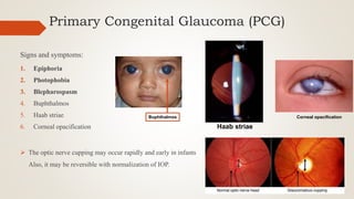 Congenital Glaucoma | PPTX