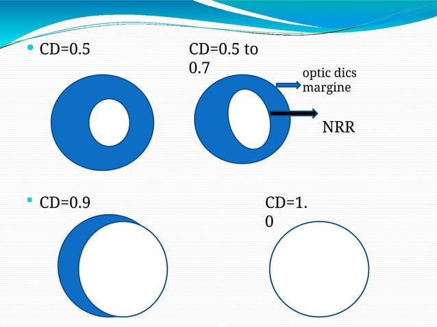 glaucoma4 human eye ,disease eye first.pptx