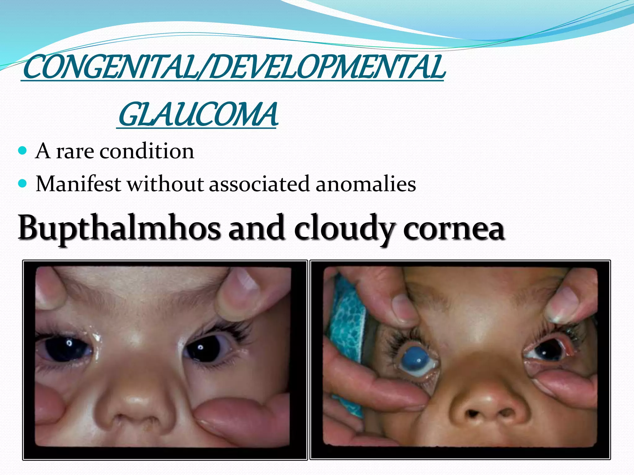 Glaucoma | PPTX